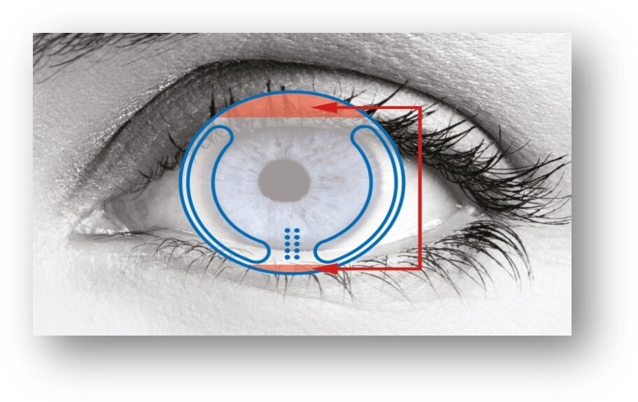 Menicon PremiO Toric | Products | Professional | Menicon